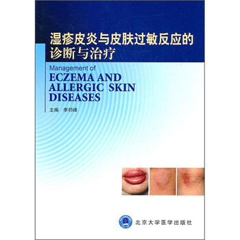 湿疹皮炎与皮肤过敏反应的诊断与治疗