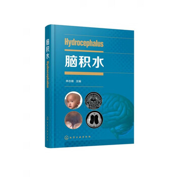脑积水(精)