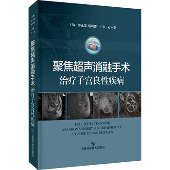 聚焦超声消融手术治疗子宫良性疾病