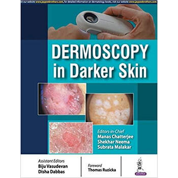Dermoscopy in Darker Skin