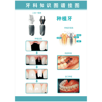 牙科宣传画口腔科海报牙齿结构功能知识解剖图谱挂图墙贴画WSA54 WSA54-08 种植牙 40x60cm  PP覆膜贴纸