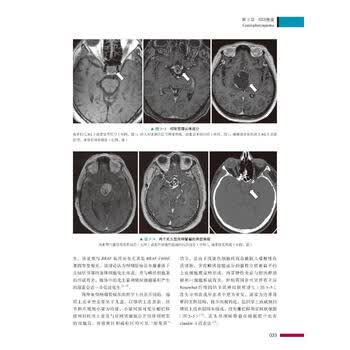 成人中枢神经系统肿瘤放射治疗学：从理论到实践 图书