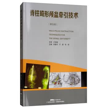 脊柱畸形颅盆牵引技术（普及版）