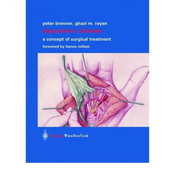 Dupuytren's Disease: A Concept of Surgical T...